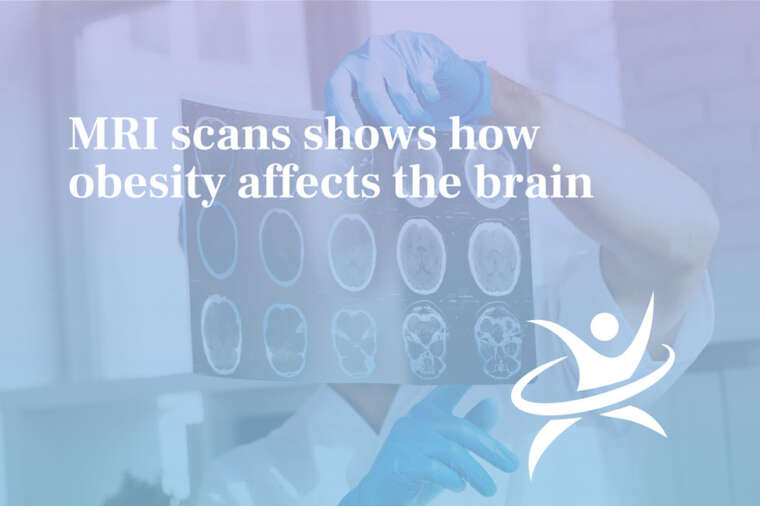 MRI scans shows how obesity affects the brain - My New Body